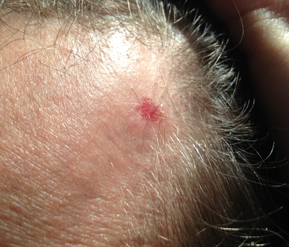 Moles and apple cider vinegar